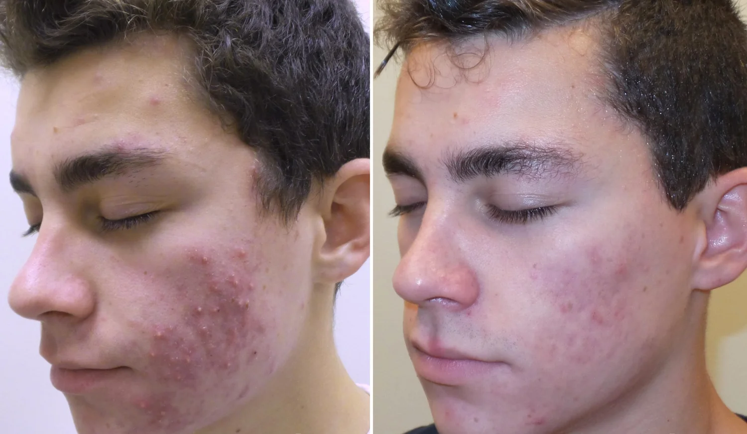 Aerolase Neo Elite Laser — The Skin Company Bermuda