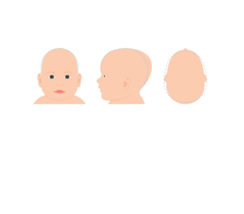 Baby Flat Head Syndrome: Chiropractic Treatment & Prevention — The Well ...