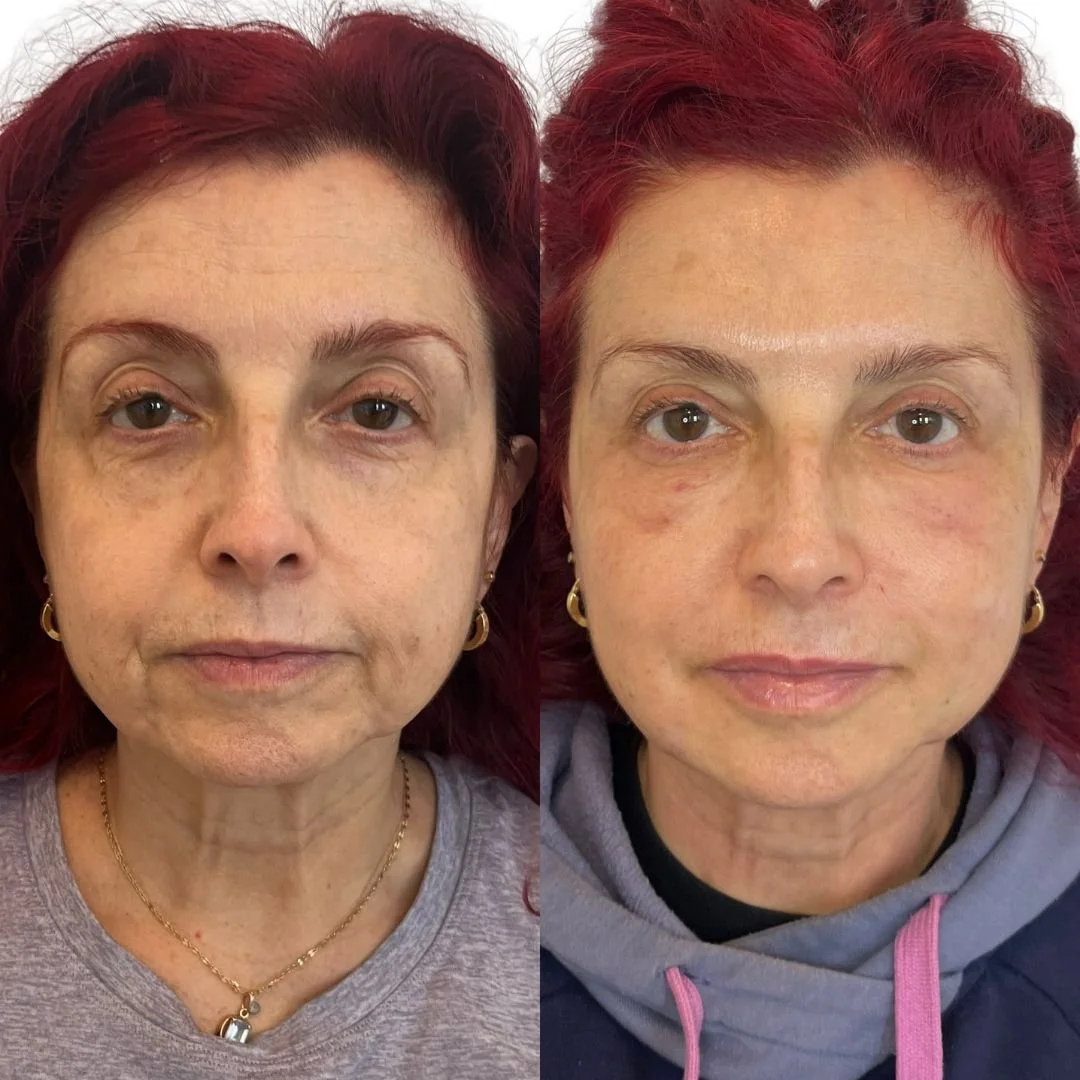 Natural PRP Filler — SLB Medical Aesthetics Collingwood | New Liskeard