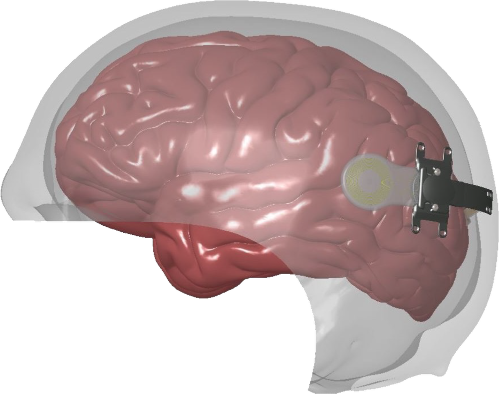 Pipeline — Cortigent | Powering brain connections to restore body functions.