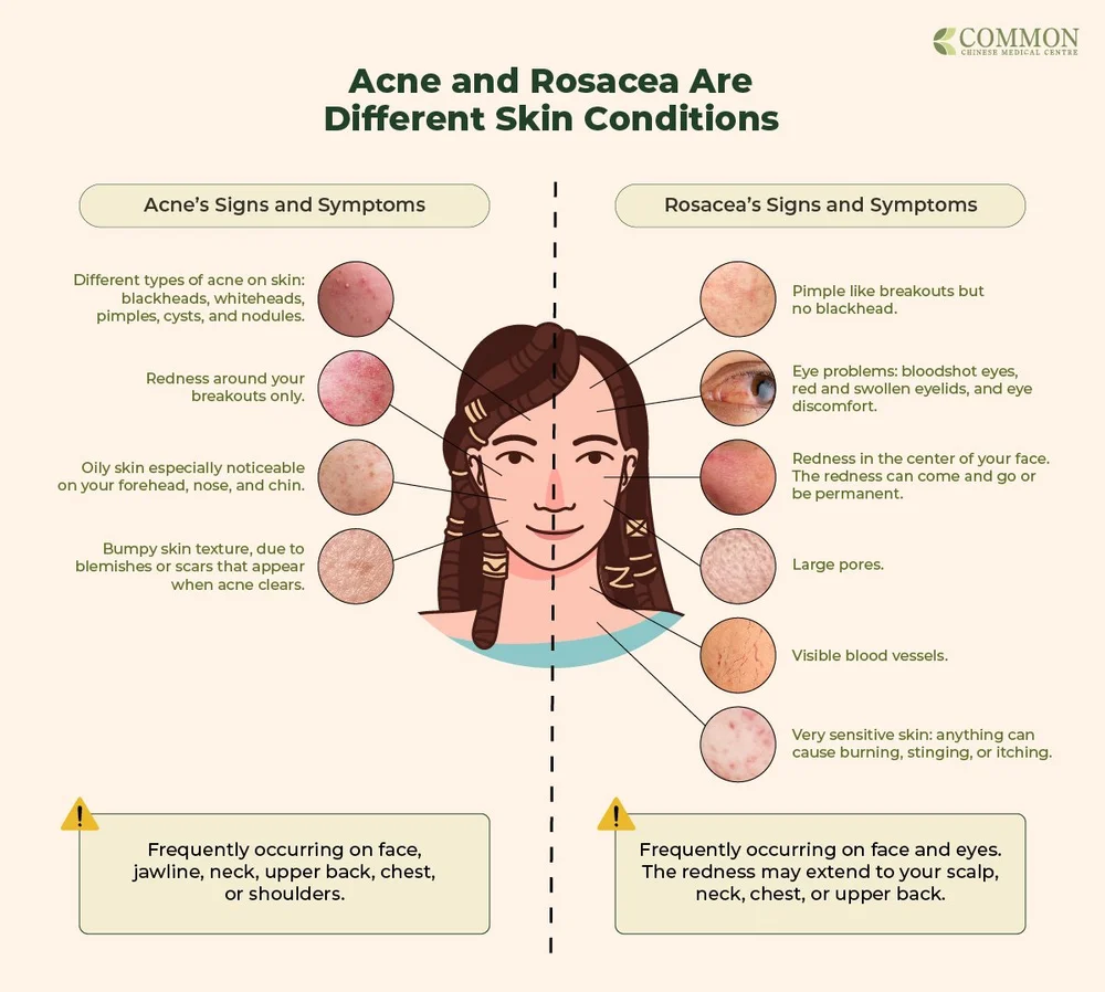 Managing Acne Using Traditional Chinese Medicine (TCM) Treatment