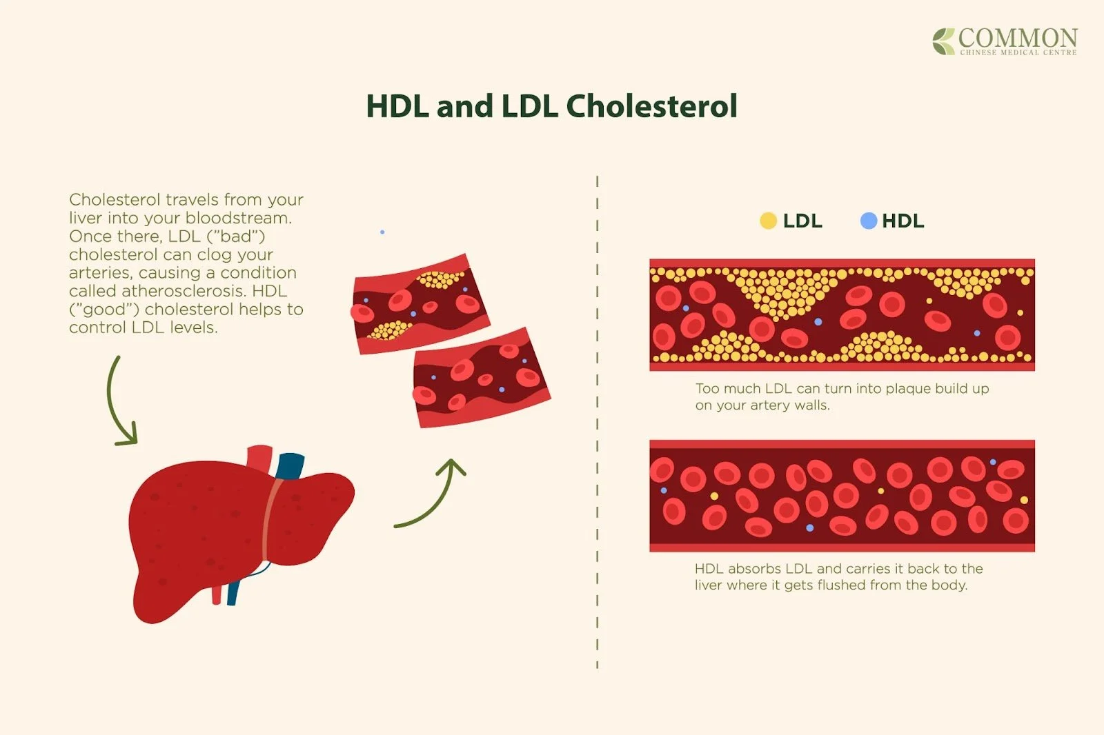 Best TCM Methods in Singapore for Managing High Cholesterol