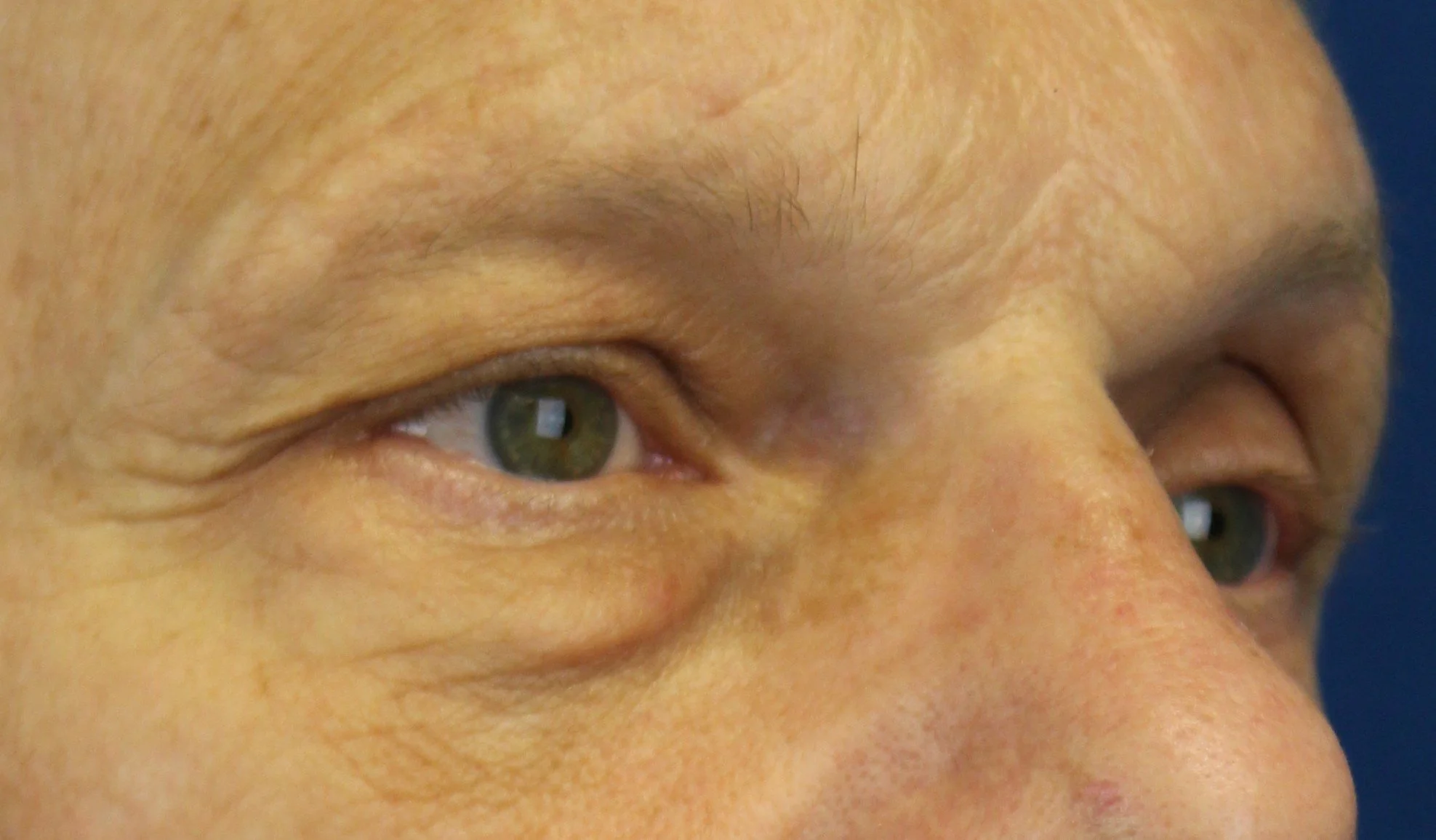 Eyelid & Eyebrow Surgery — UVA Facial Plastic Surgery