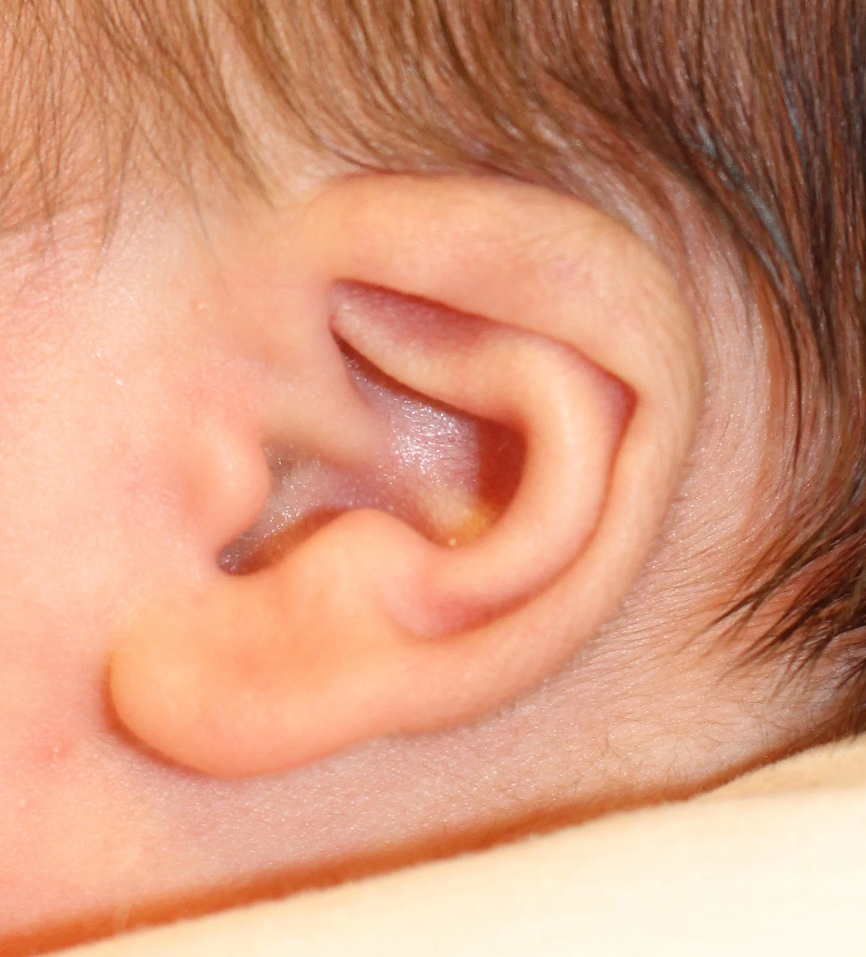 Ear Deformity Correction — UVA Facial Plastic Surgery