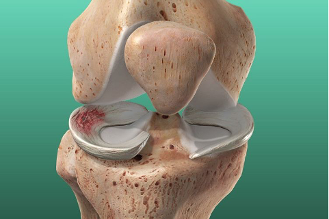 ¿Qué es una lesión de menisco? — Top Clinic | Centro de Especialidades ...
