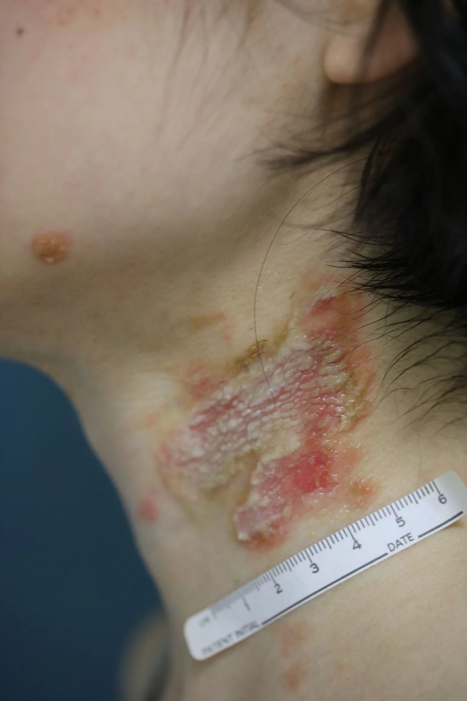 Services — Australasian Blistering Diseases Foundation
