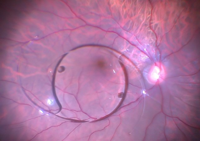 Common Vitreoretinal Diagnoses — Orange Ivy Retina