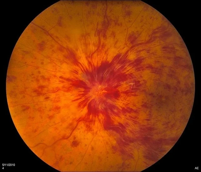 Common Vitreoretinal Diagnoses — Orange Ivy Retina