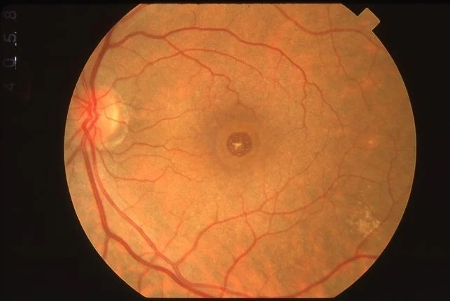 Common Vitreoretinal Diagnoses — Orange Ivy Retina
