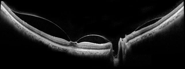 Common Vitreoretinal Diagnoses — Orange Ivy Retina