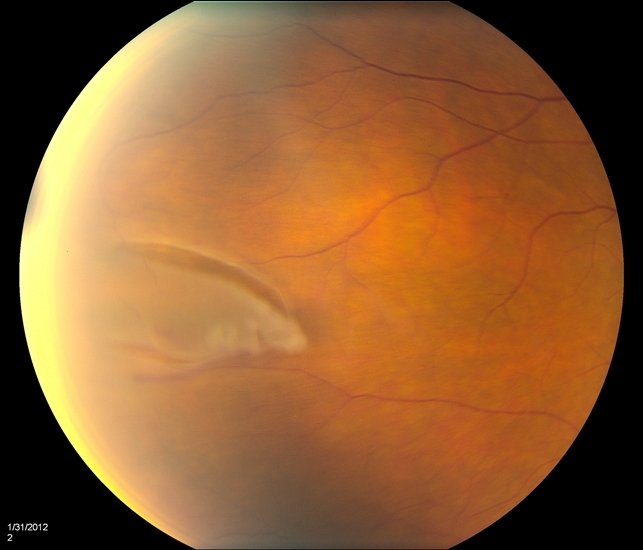 Common Vitreoretinal Diagnoses — Orange Ivy Retina