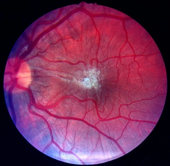Common Vitreoretinal Diagnoses — Orange Ivy Retina