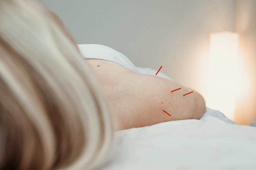 Acupuncture by Andrea