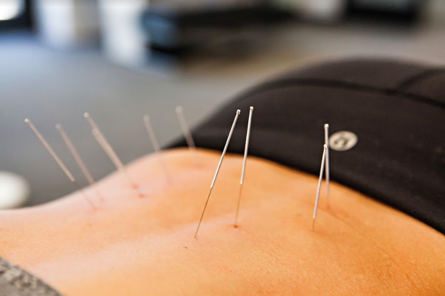 Dry Needling - Currumbin — Morning Osteopathy.
