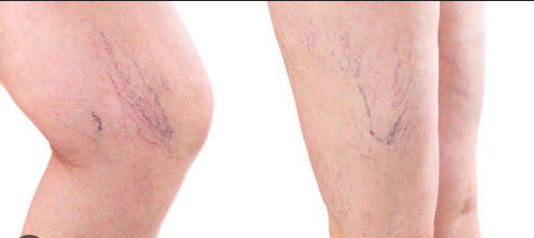 How Sclerotherapy Treatment in Dundas Helps Reduce Spider and Small ...