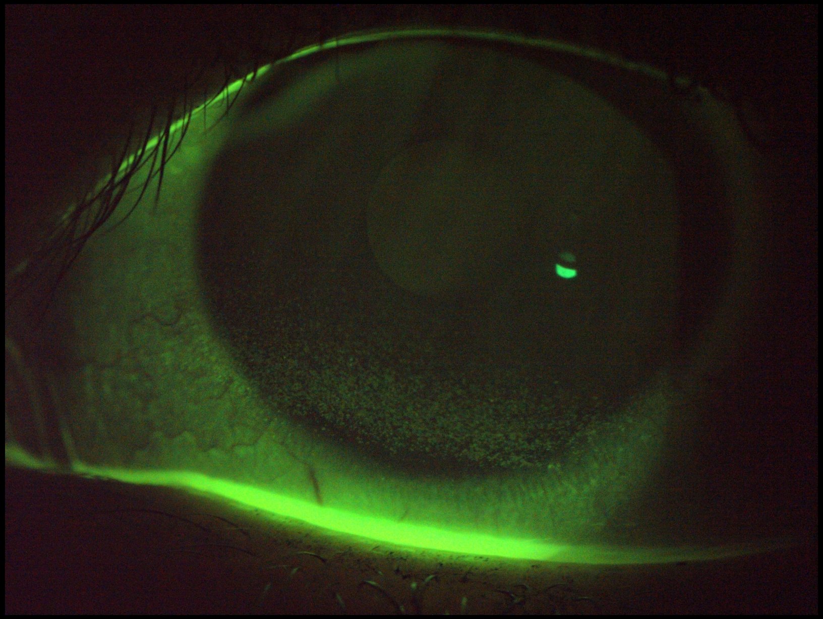 Dry Eye & Ocular Surface Evaluation — Ophthalmic Clinical Trials