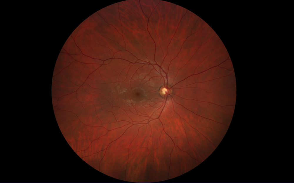 Posterior Eye & Retinal Imaging — Ophthalmic Clinical Trials
