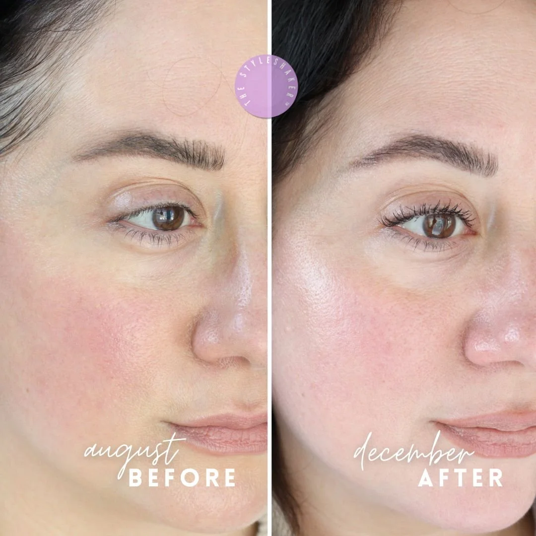 My Honest Review of the ZIIP Halo Facial Toning Device, Update!