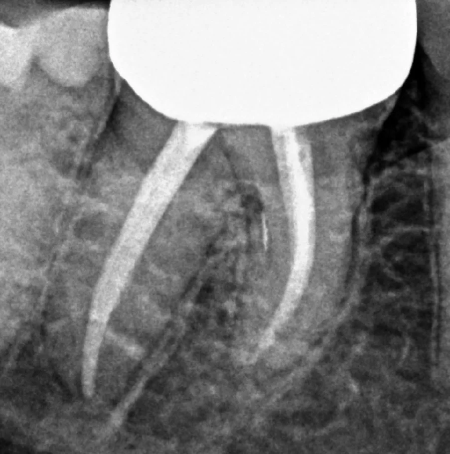 Root Canal Treatment Dentist In Kitsilano Vancouver Accord Dental