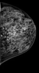 Breast Cancer — Dr Simone Geere