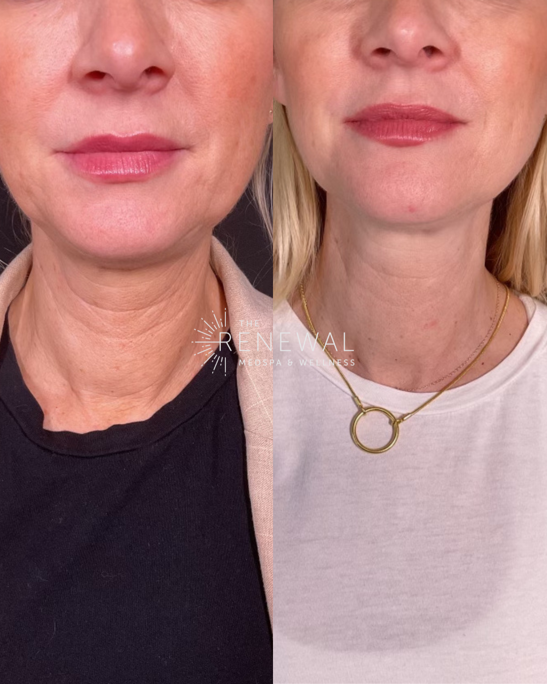 Before & Afters — The Renewal Medspa