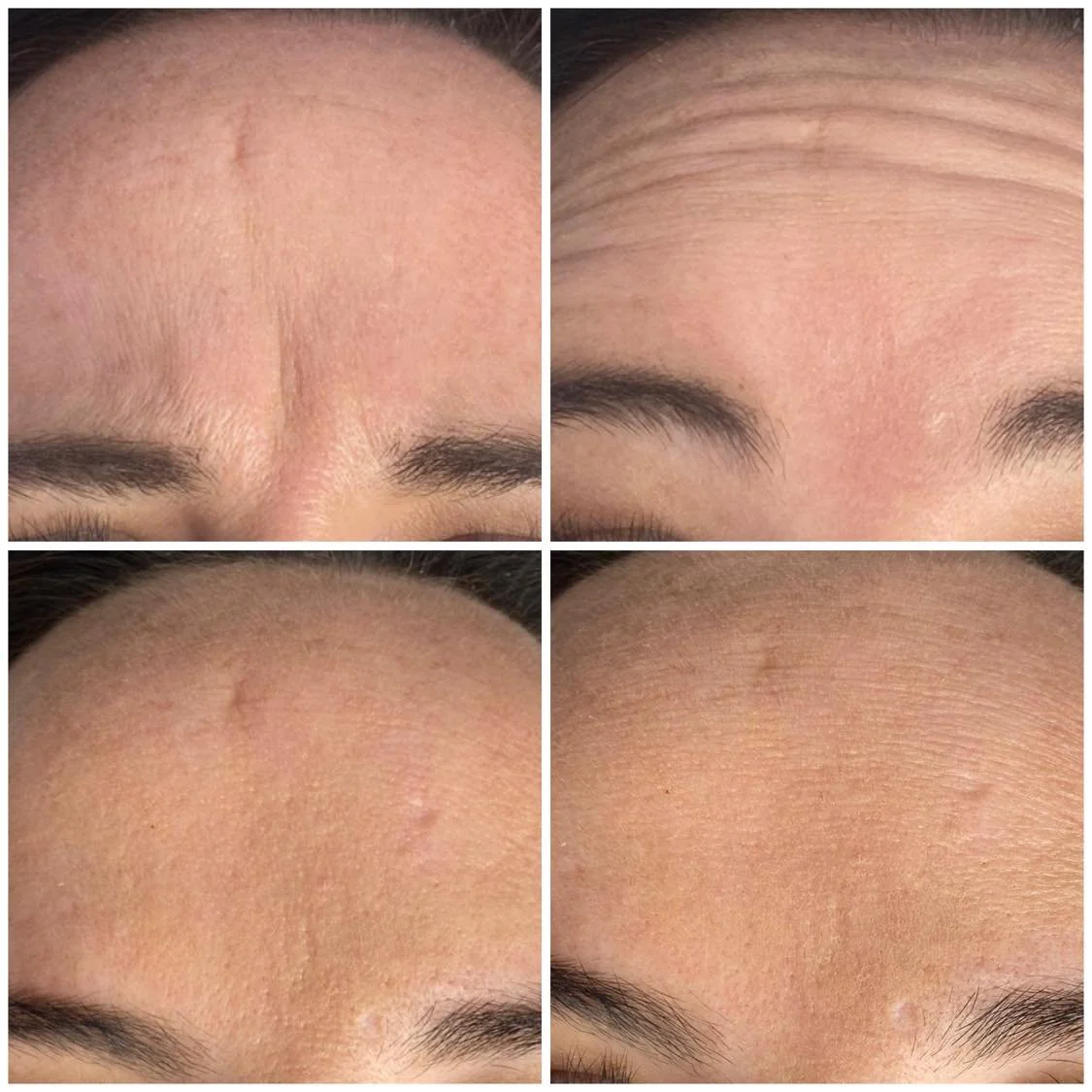 Treatment to improve appearance of wrinkles — aesthetics culture and skin