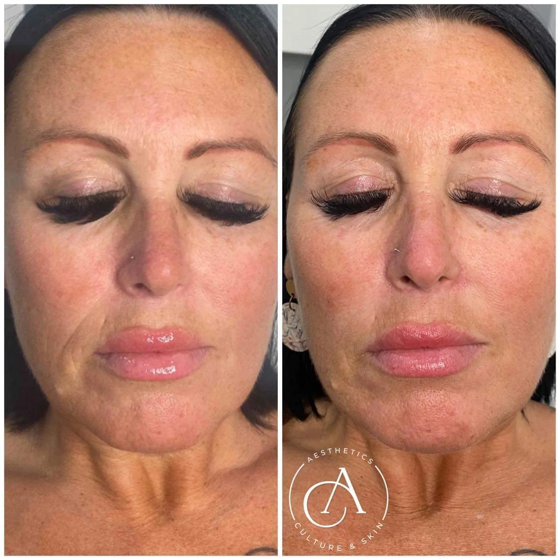 Treatment to improve volume loss | Enhance Your Appearance Today ...