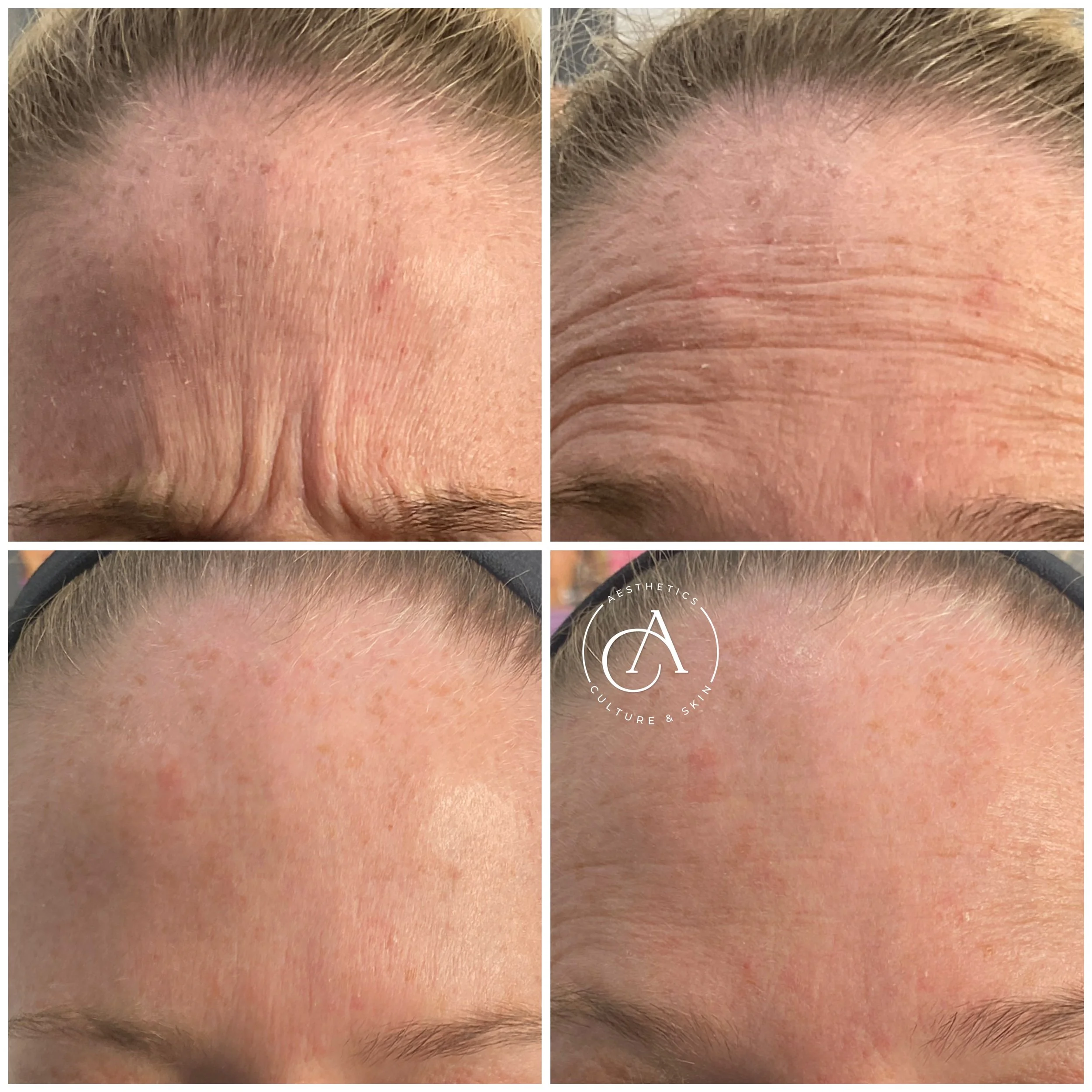Treatment to improve appearance of wrinkles — aesthetics culture and skin