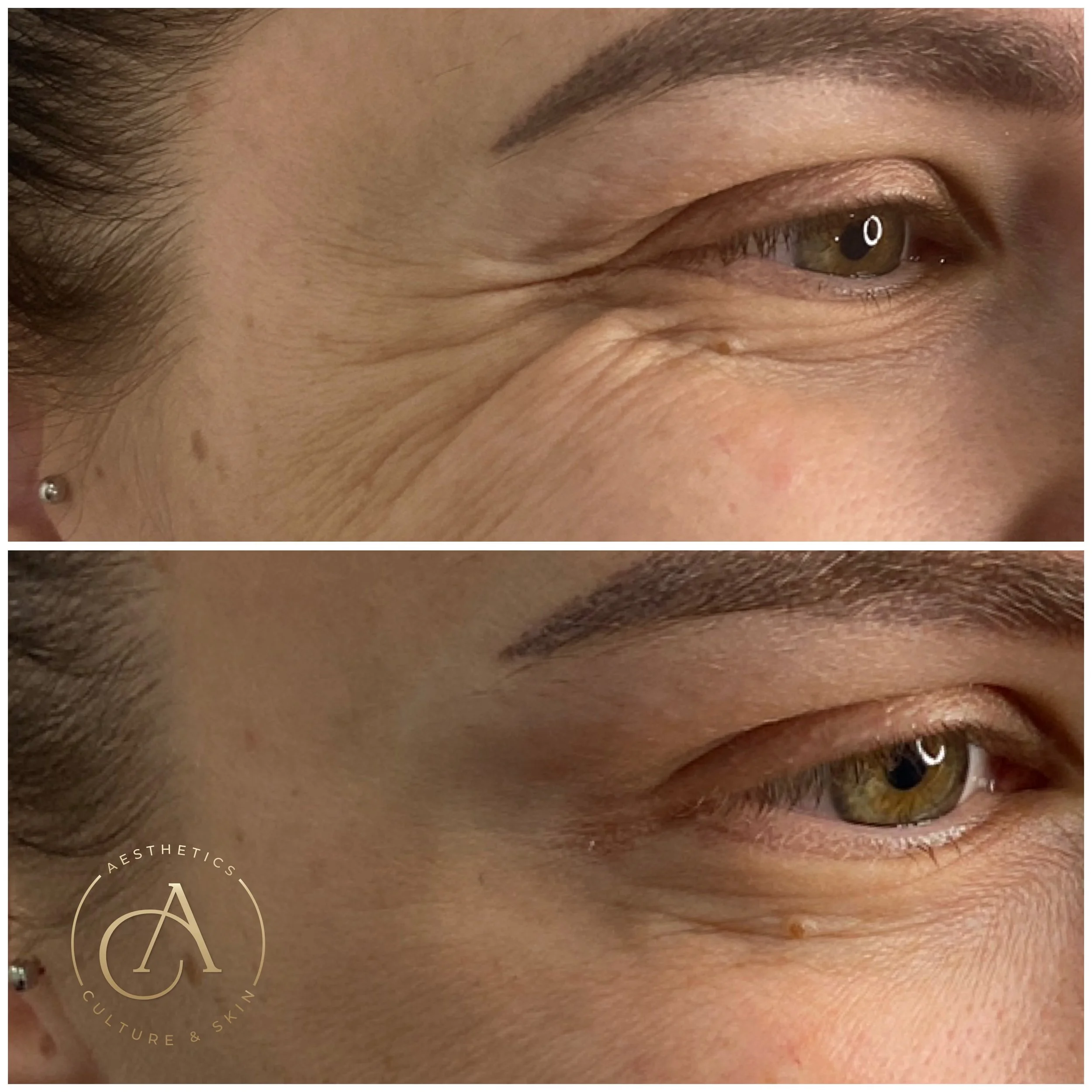 Treatment to improve appearance of wrinkles — aesthetics culture and skin