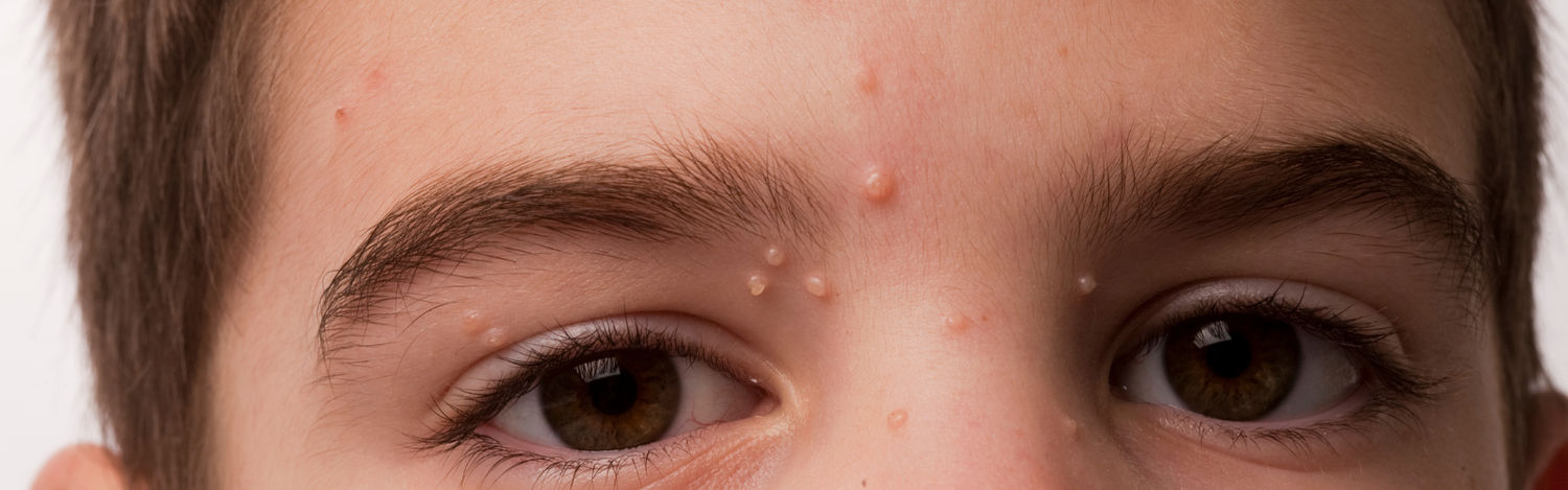 Molluscum — Lenzy Dermatology