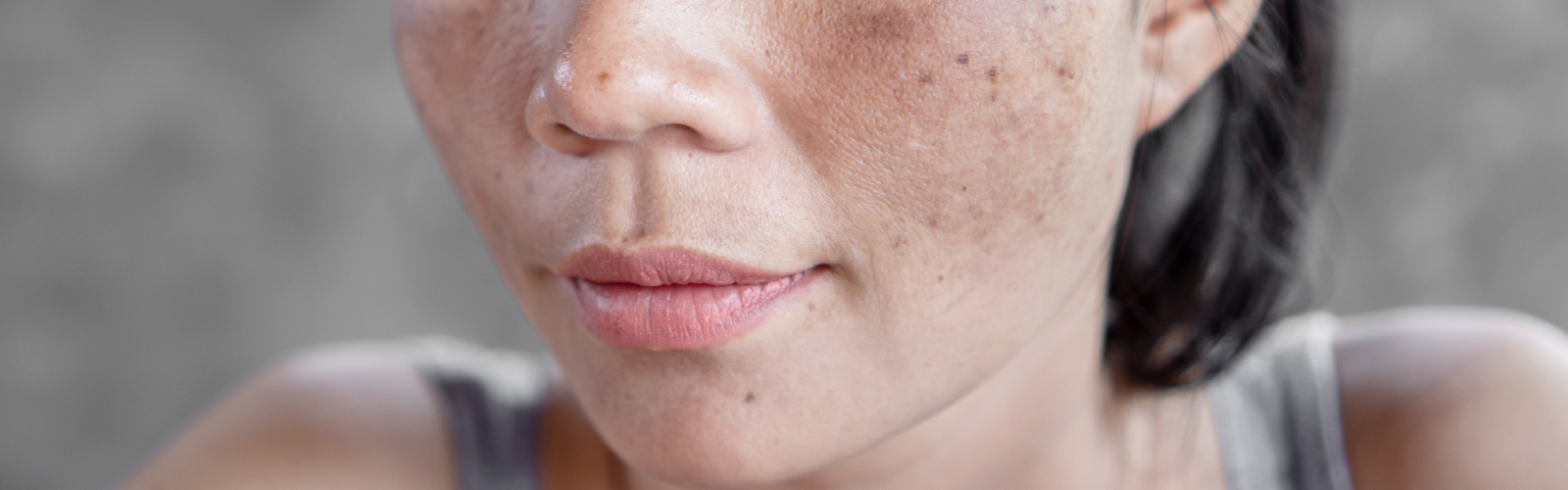Hyperpigmentation — Lenzy Dermatology