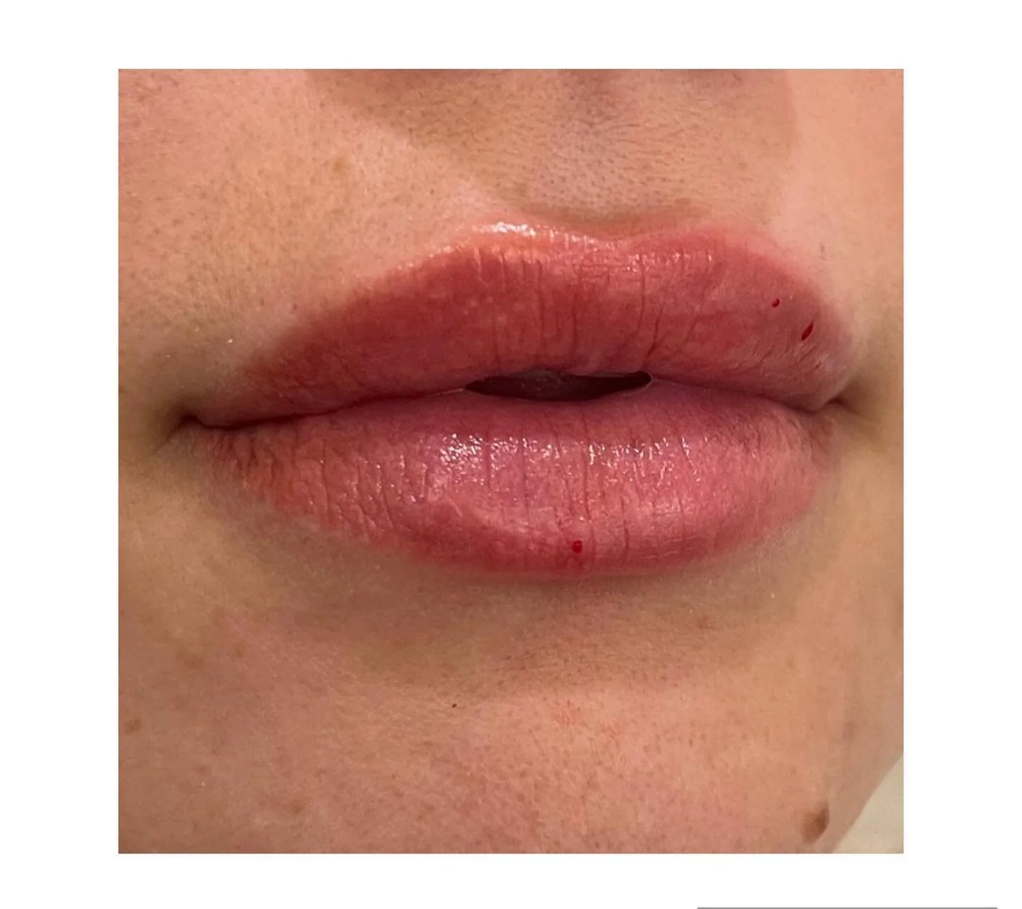 BEFORE + AFTER — Carla Click Medical Aesthetics