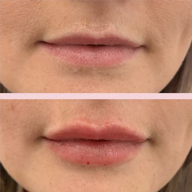 Before & After — Carla Glick Medical Aesthetics