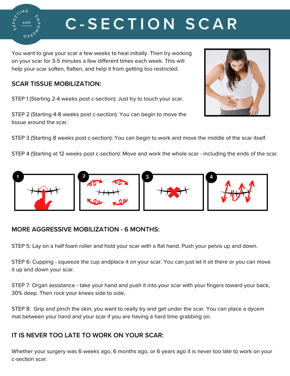C-Section Scar Mobilization — Expecting & Empowered