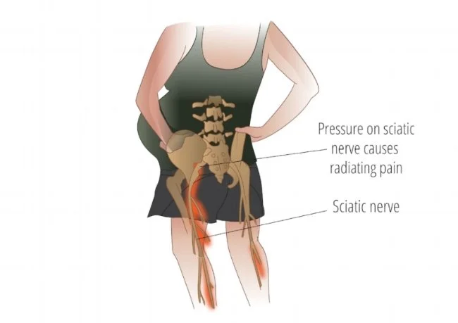 Sciatica in Pregnancy: Causes and At-Home Pain Relief — Expecting ...