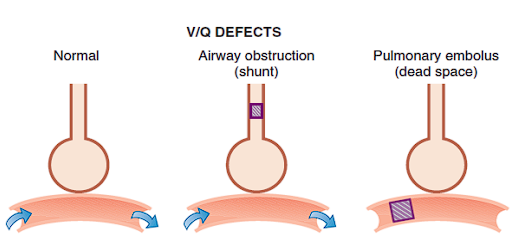 Hypoxemia and the Blood Gas — NYP Emergency Medicine Residency