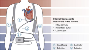 Crashing LVAD: Beyond the Basics — NYP Emergency Medicine Residency