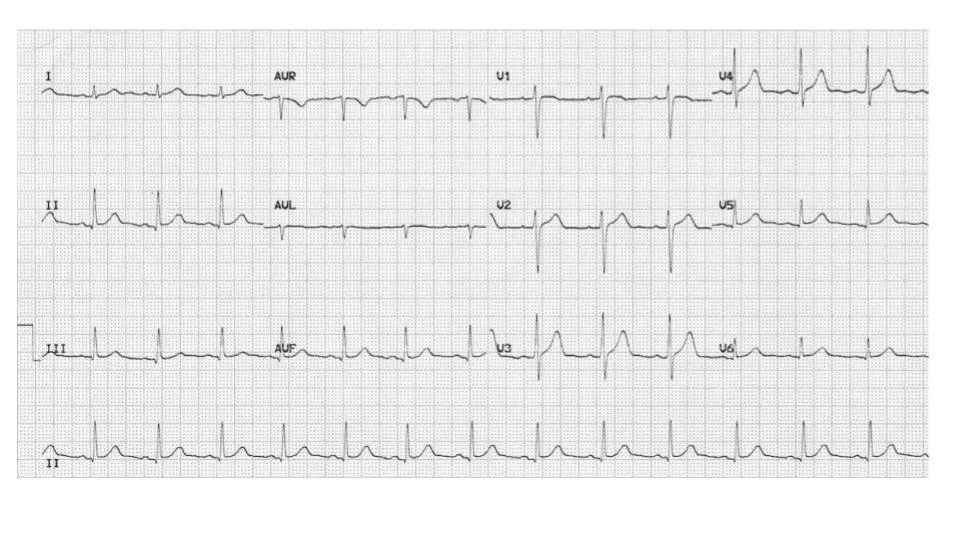Let’s Get Serial: The Importance of Serial ECGs in the Emergency ...