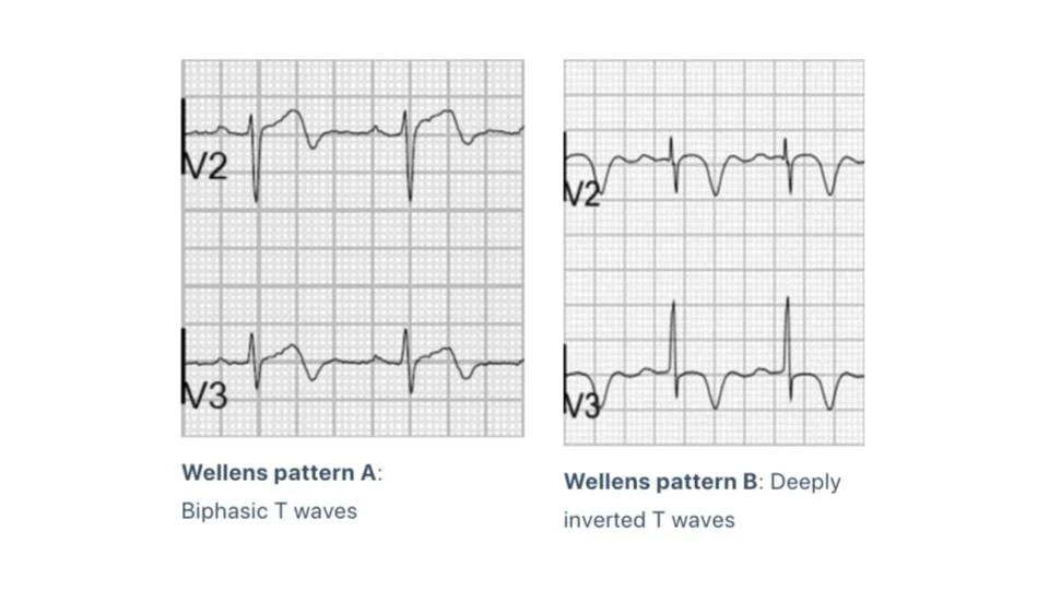 Let’s Get Serial: The Importance of Serial ECGs in the Emergency ...