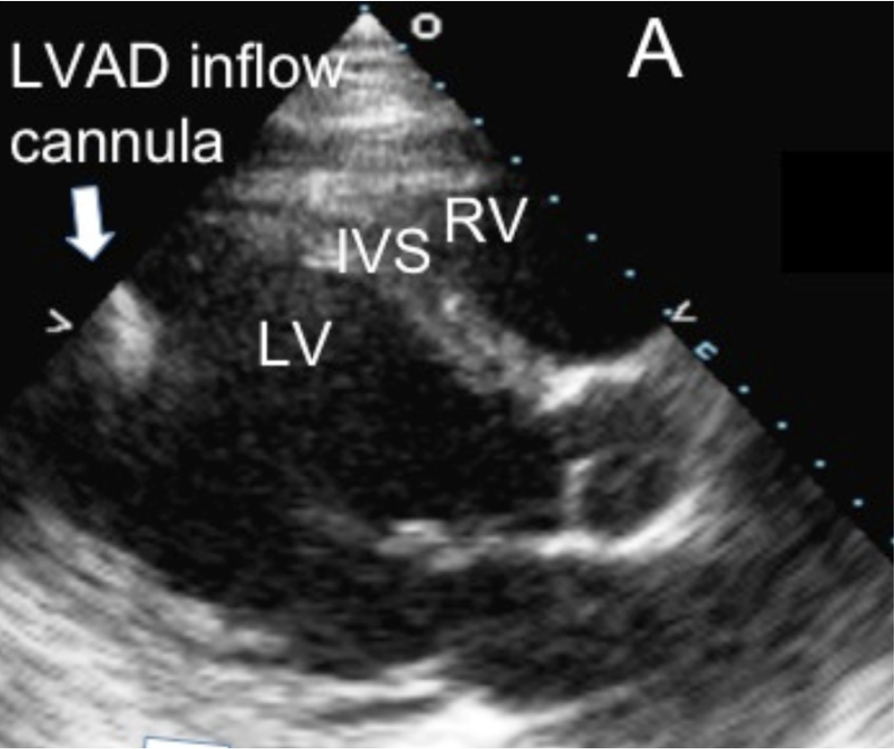 Crashing LVAD: Beyond the Basics — NYP Emergency Medicine Residency