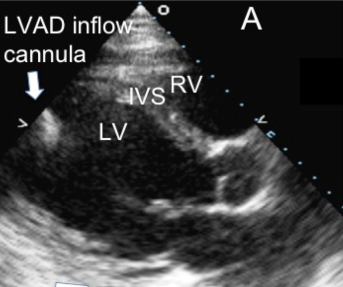 Crashing LVAD: Beyond the Basics — NYP Emergency Medicine Residency
