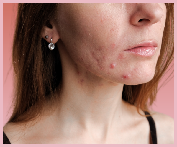 Congested and Acne-Prone Skin Causes & Treatments — The Skin Manifesto