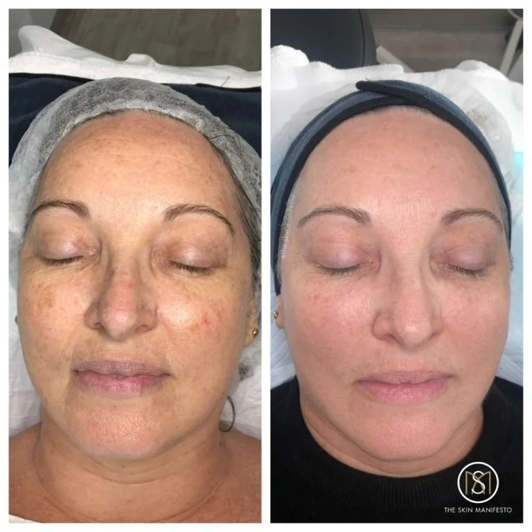 Laser Pigmentation Removal - What you need to know — The Skin Manifesto