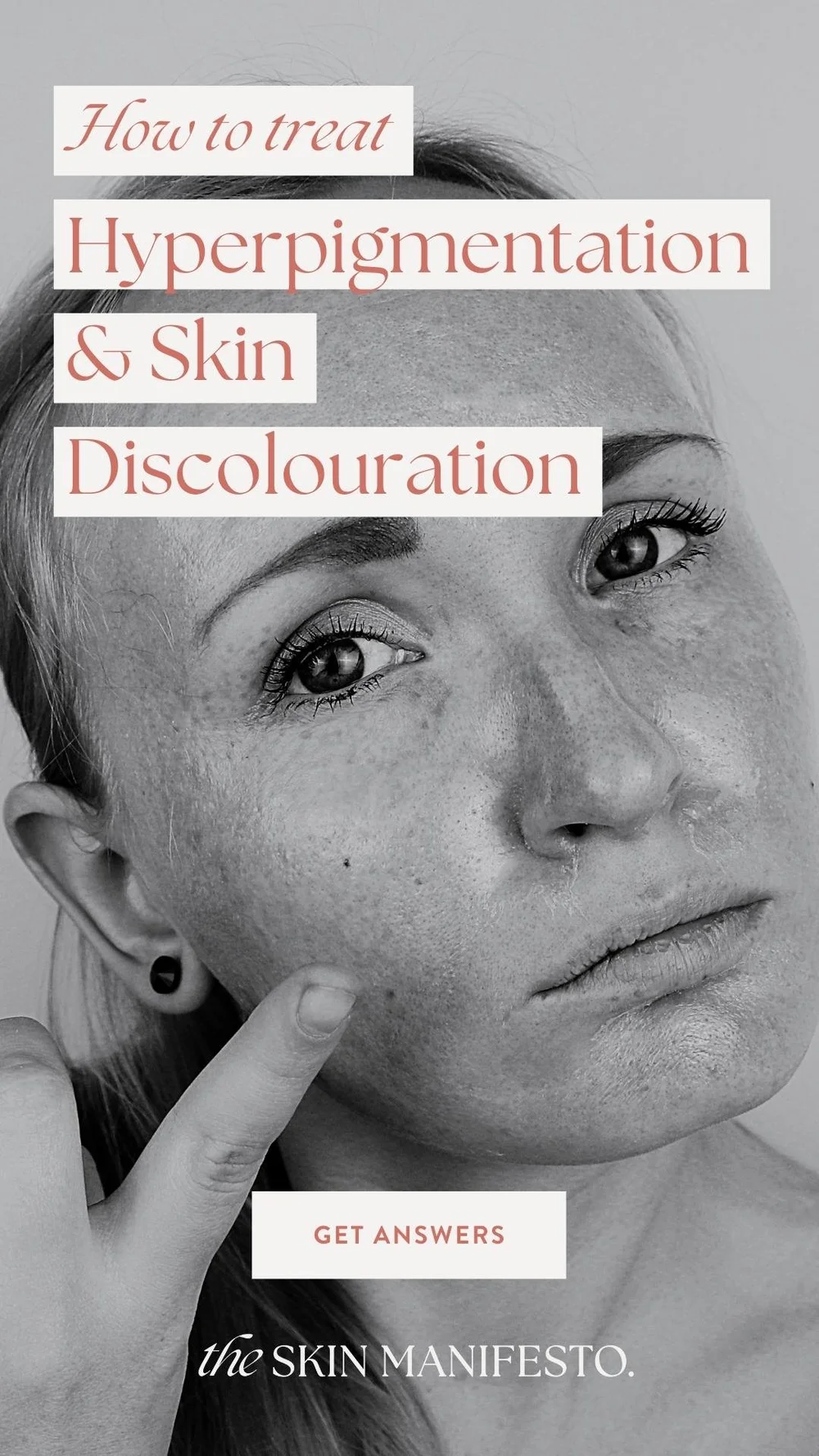Hyperpigmentation & skin discolouration: types, treatments and what ...