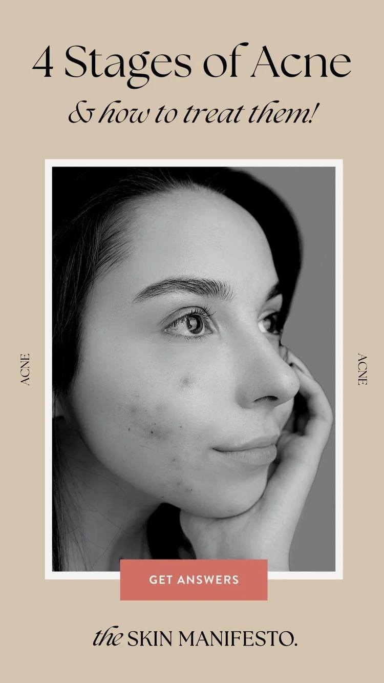 4 stages of Acne and how to treat them — The Skin Manifesto