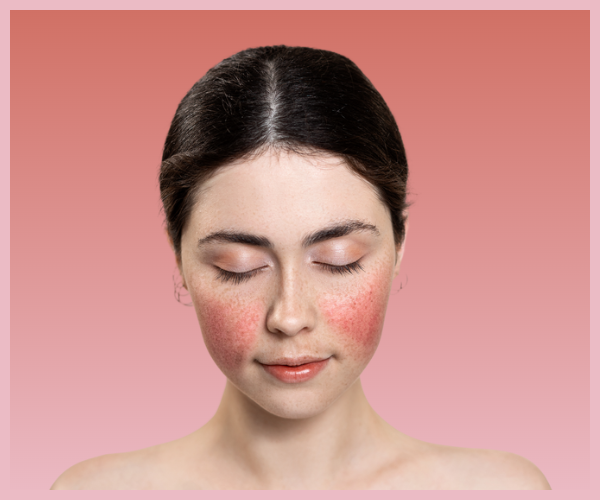 Understanding Rosacea & Sensitive Skin Causes & Treatments — The Skin ...