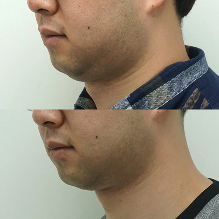 Clatuu Alpha Fat Freezing — Bare Laser and Skin