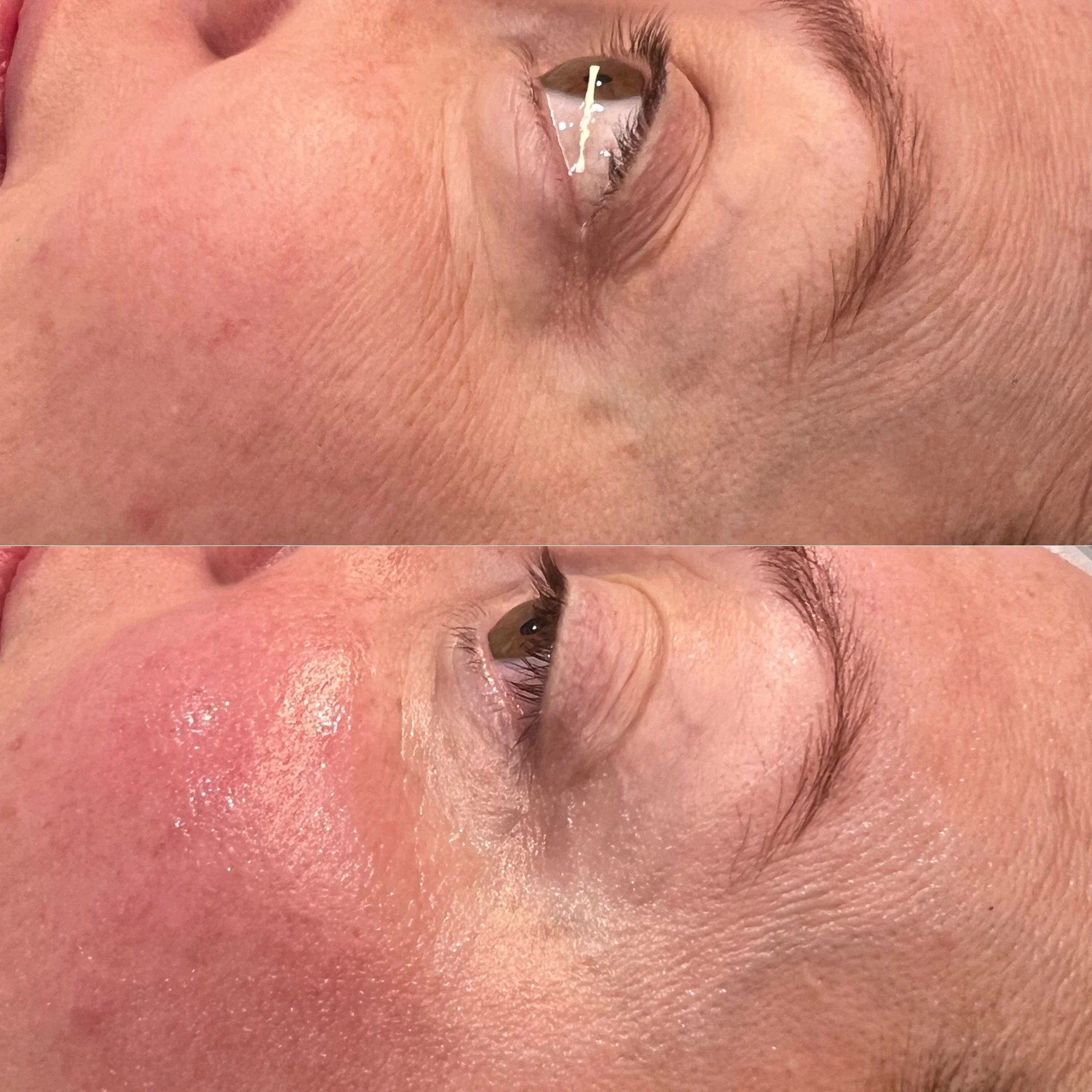 Laser Rejuvenation — Bare Laser and Skin