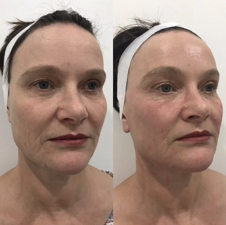 Thermage FLX Face — Bare Laser and Skin