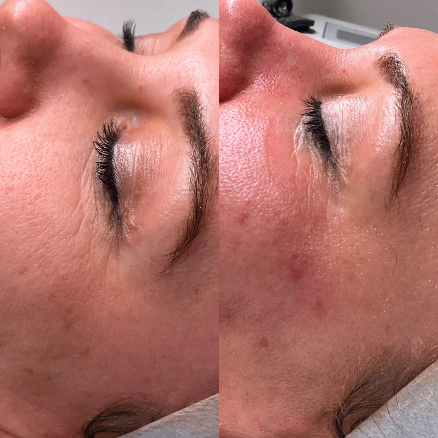 Laser Rejuvenation — Bare Laser and Skin